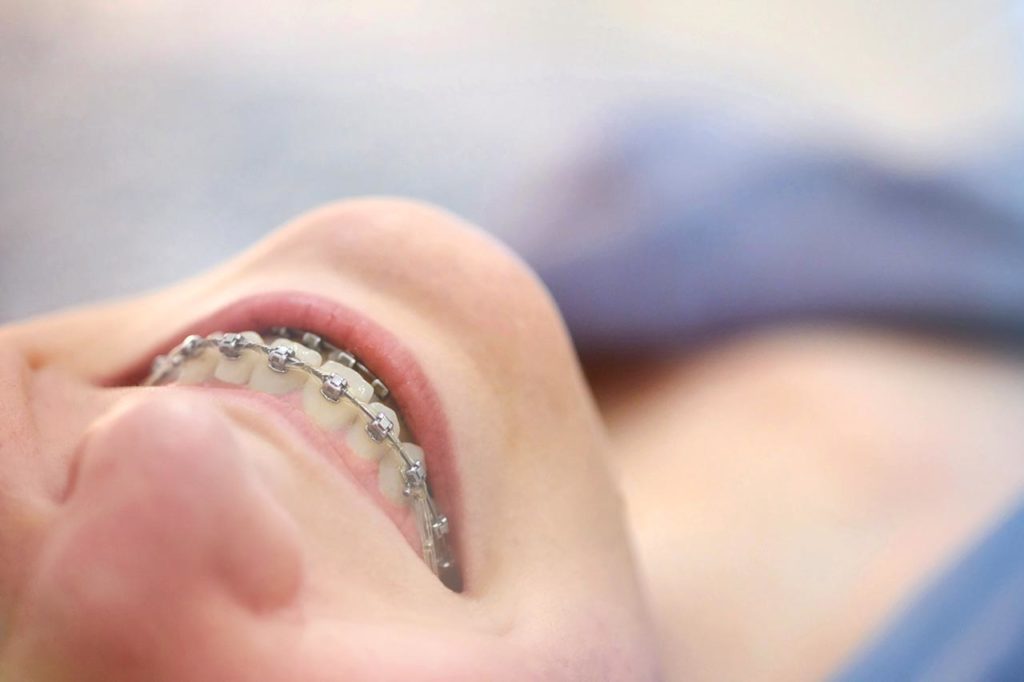 Usynlig tannregulering – et diskret alternativ for rette tenner ...
